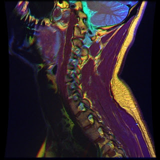 Nevit's blog: Color MRI of Cervical vertebrae