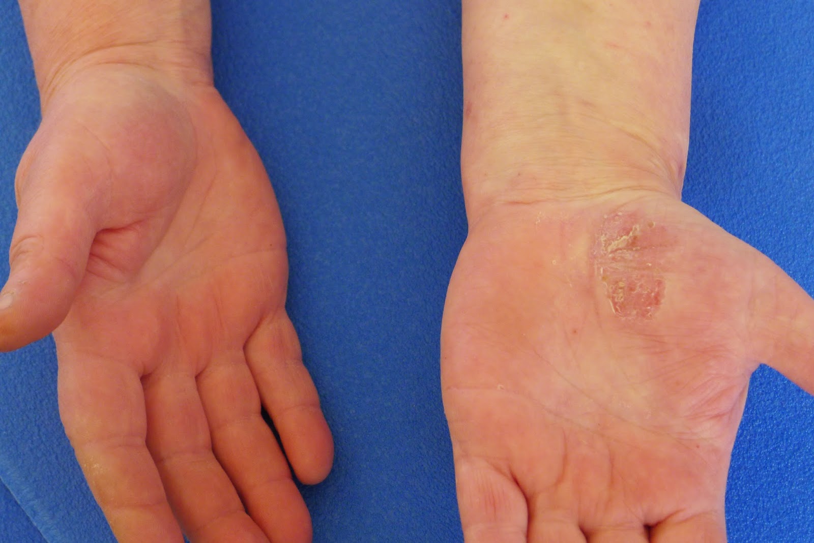 Konsultacijos: Pustulinė delnų ir padų psoriazė