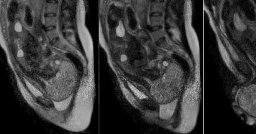 Maximizing Progress: MRI of Human Birth ~ Moment Mother Delivers!
