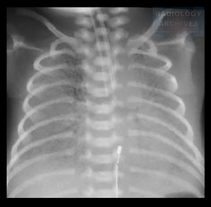 Radiology Archives: Νόσος της Υαλοειδούς Μεμβράνης (Σύνδρομο ...