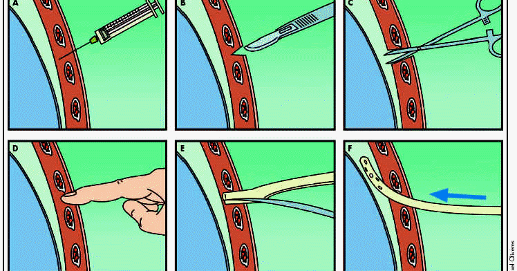 MEDICINA: Guía para la práctica de toracentesis y de toracostomia ...