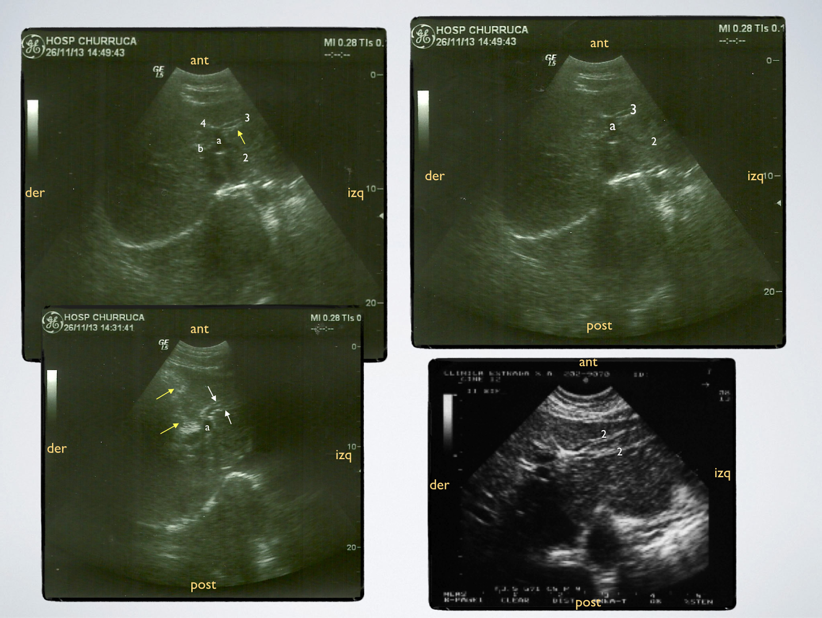 Cuadernos de Anatomía Quirúrgica: Segmentación hepática en ecografía.