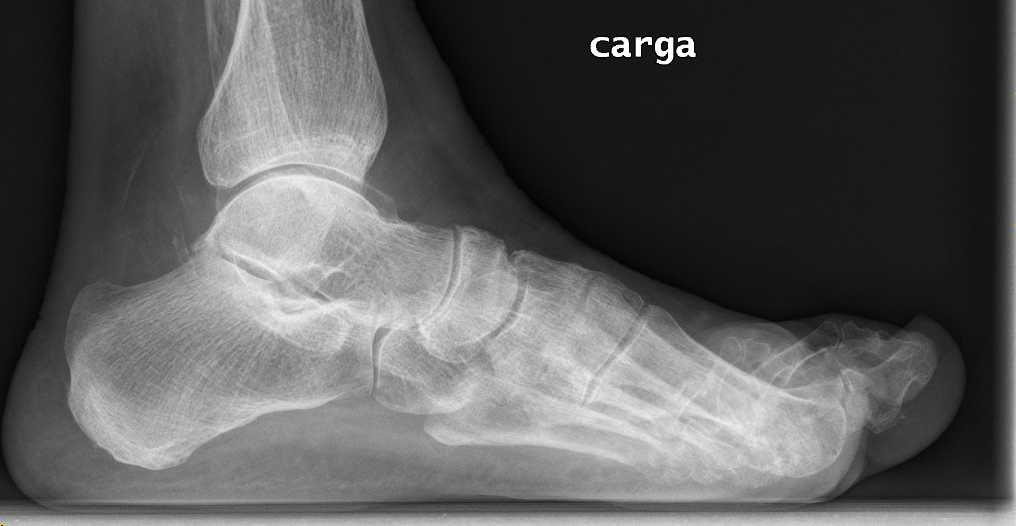 Fanáticos del pie: ATLAS DE PATOLOGÍA DEL PIE: ANTEPIE REUMATICO SEVERO