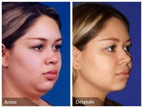 Más que sólo una cara bonita: ¿Chachetón? Bye a los cachetes grandes