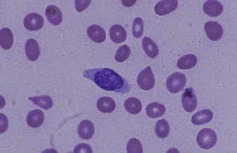 FICHERO DE HEMATOLOGIA: LLC- LEUCEMIA DE CÉLULAS PILOSAS (Tricoleucemia)