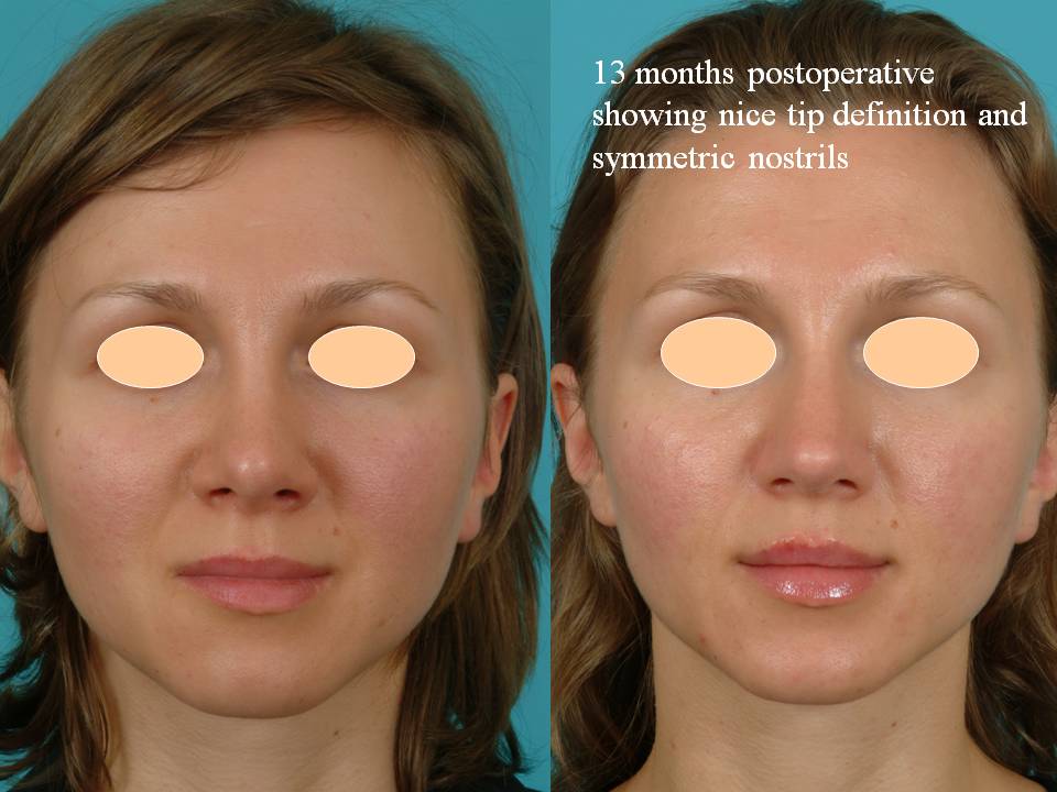 Dr. Dean Toriumi Reviews: Dean Toriumi Reviews: Patient that underwent ...