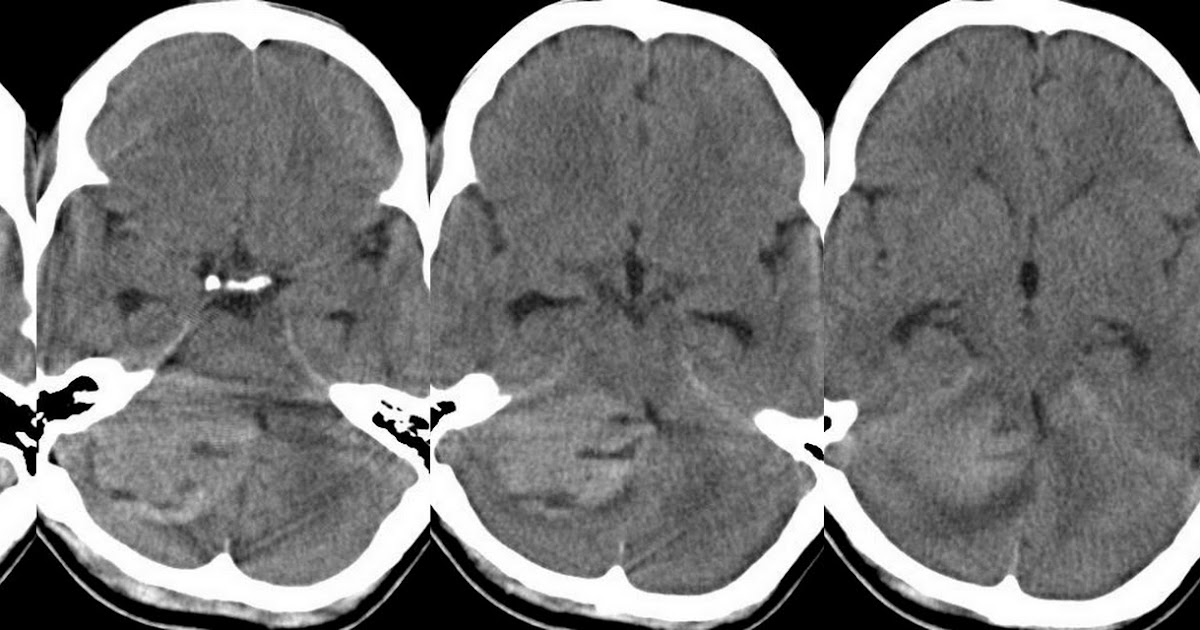Neuroradiology Cases: Medulloblastoma (Lateral origin)