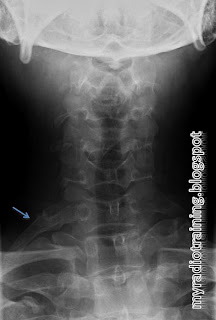 Radiology info hub: Normal Variant: Cervical Rib