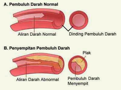 Penyakit dan Kelainan pada Sistem Peredaran Darah (1) | IPA Teman Belajarku