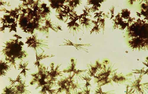 [Haematology] Microscopic Examination of Urinary Sediment - Crystals ...