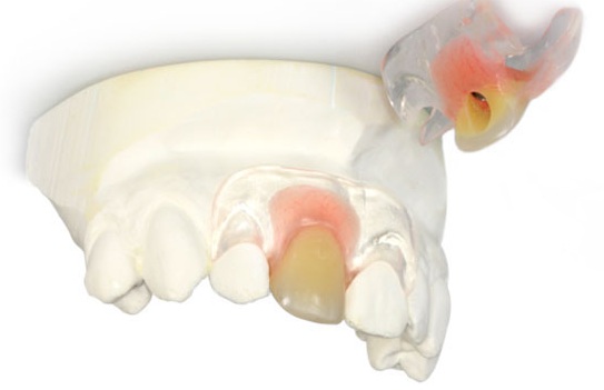 Dental flipper choices - What are your options? What's cost?