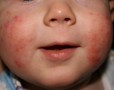 Chipping, Crusty Skin on the Scalp - Baby Station