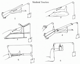 Lifenurses: Nursing Care Plan for Bone Fractures