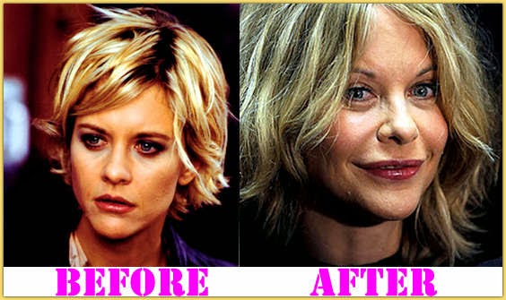 Celebrities Plastic Surgery: Meg Ryan Plastic Surgery - One of the Bad ...