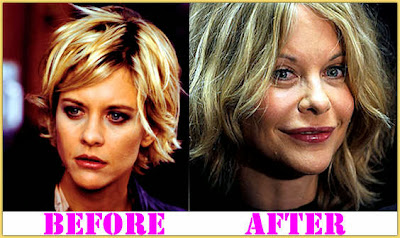 Celebrities Plastic Surgery: Meg Ryan Plastic Surgery - One of the Bad ...