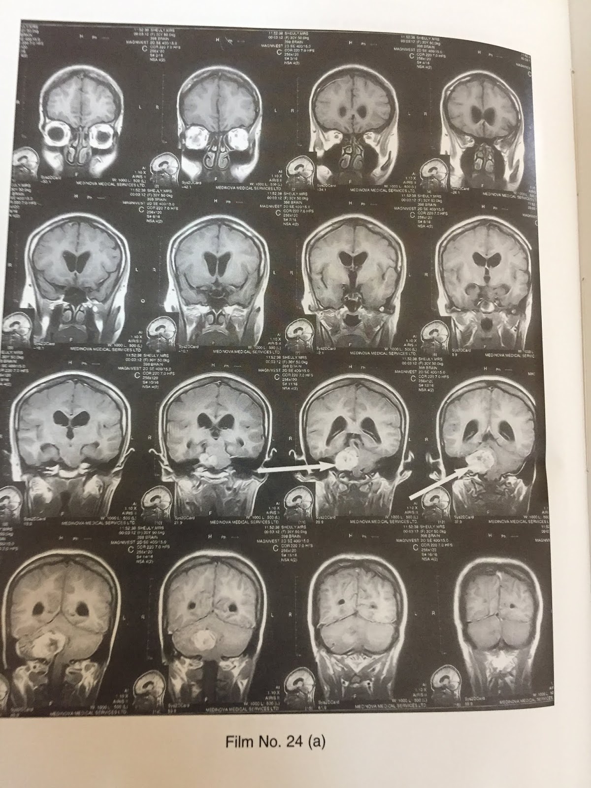 CT SCAN OF BRAIN-12