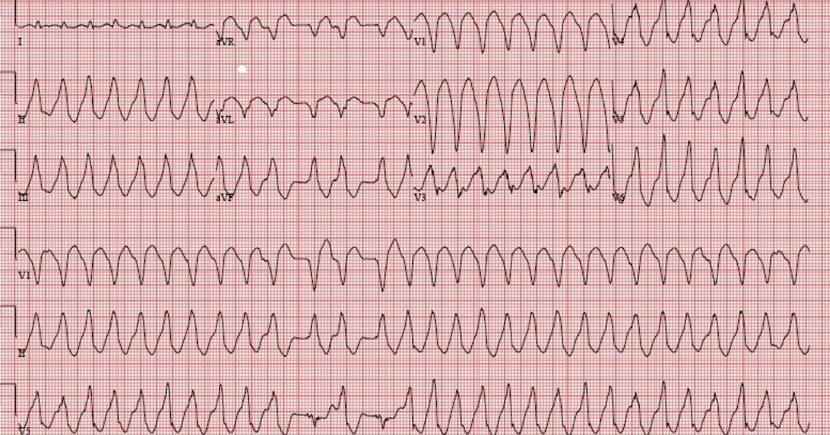 Dr. Smith's ECG Blog: ED Case of Catecholaminergic Polymorphic ...