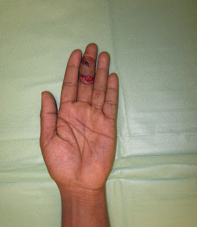 CRUSH INJURIES OF HAND AND UPPER LIMB INJURIES: DISTALLY BASED PALMAR ...