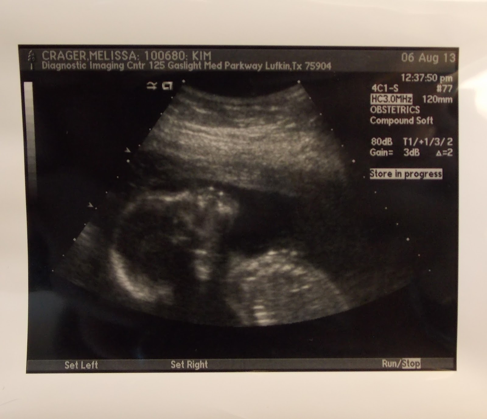 22 week ultrasound