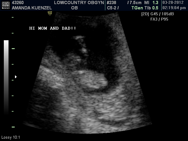 Amy's World: 11 week ultrasound