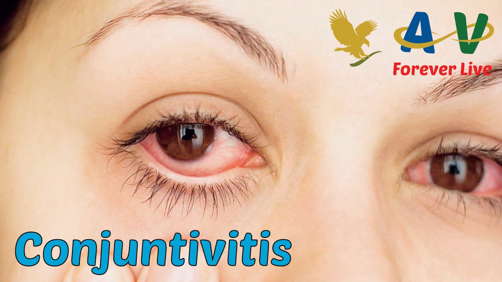 Conjuntivitis | Salud y Belleza Forever