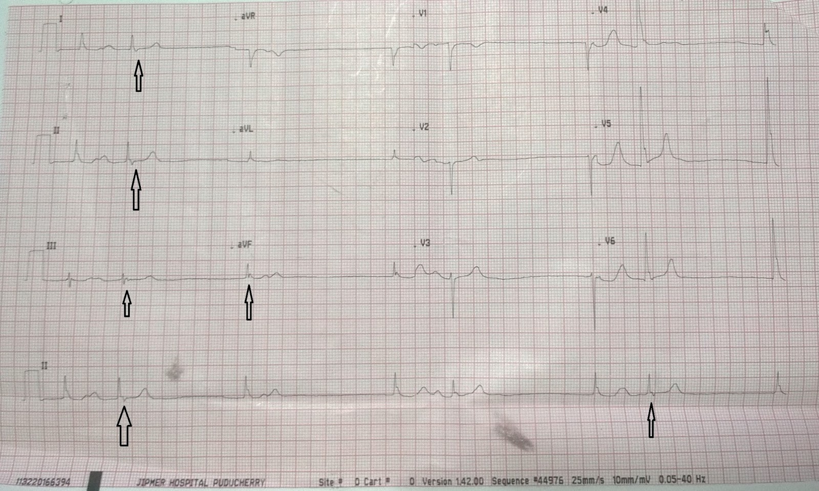Cardiology window: Sinus node dysfunction