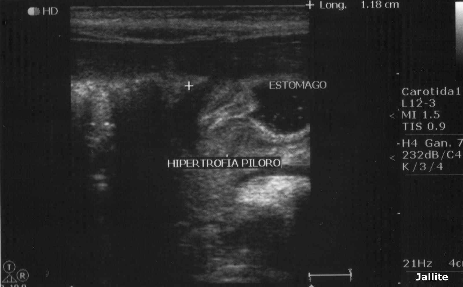 Estenosis Hipertrofica Piloro