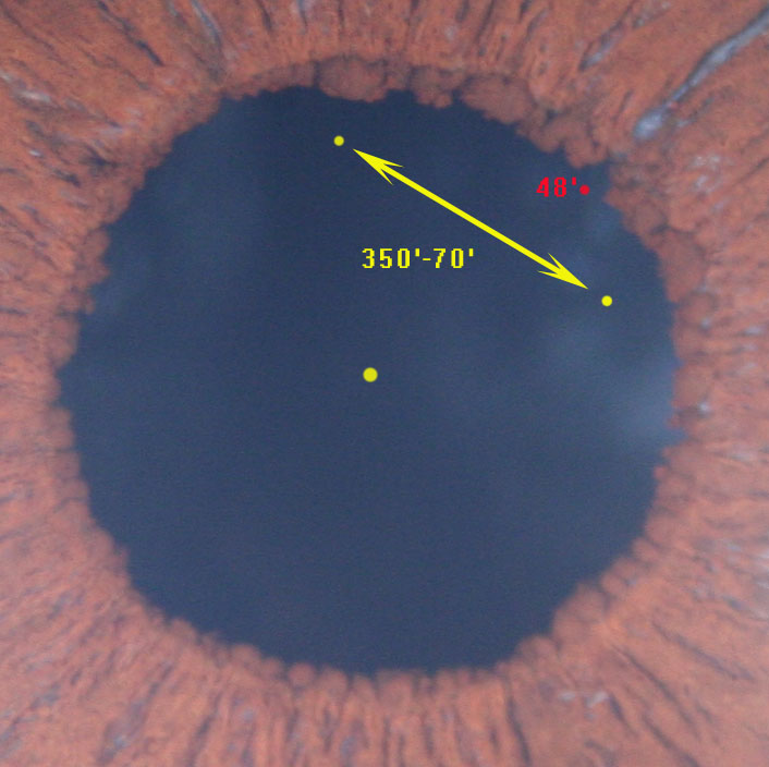 Modern & Multidimensional Iridology: Irregularity of The Frontal ...