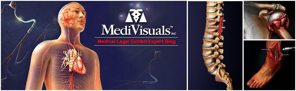 The Medical Legal Exhibit Expert Blog: Pneumothorax, Hemothorax ...