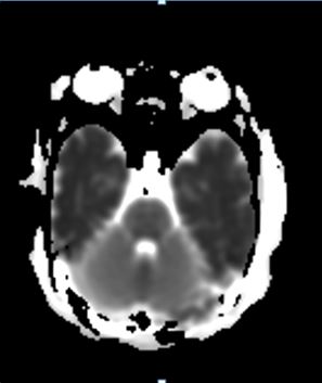 pediatric neurology: The consequence of a reversal sign
