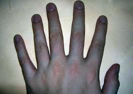 Blog Auxiliar de Enfermería sgc: ¿Qué gen causa la polidactilia?