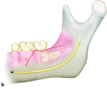 Dentistry and Medicine: Impacted Mandibular 3rd Molar Classification ...