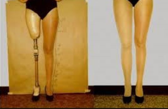 Endoskeletal and Exoskeletal Prosthesis