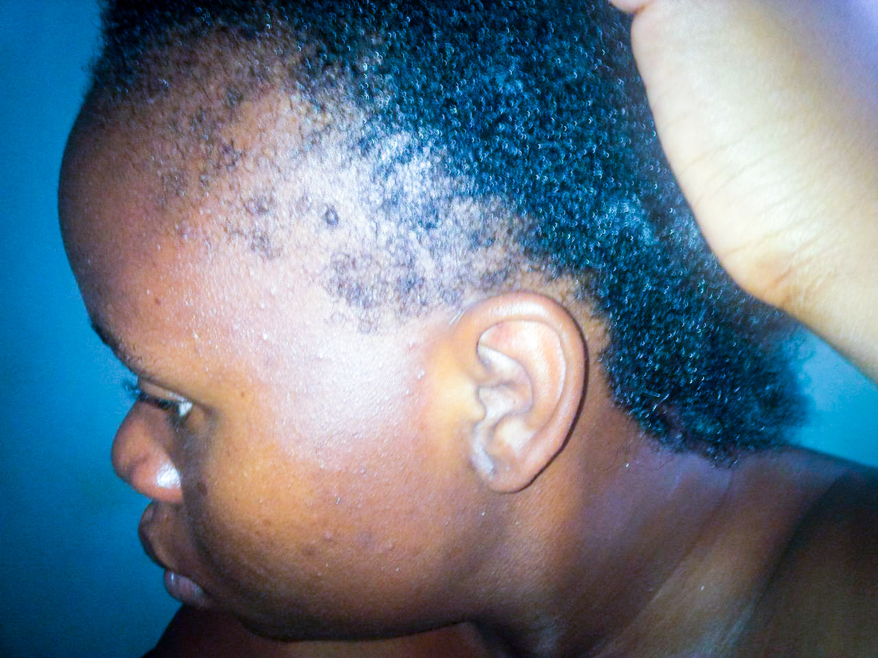 Unrealistic Expectation Regrowing Bald Edges || Natural Hair Problems ...