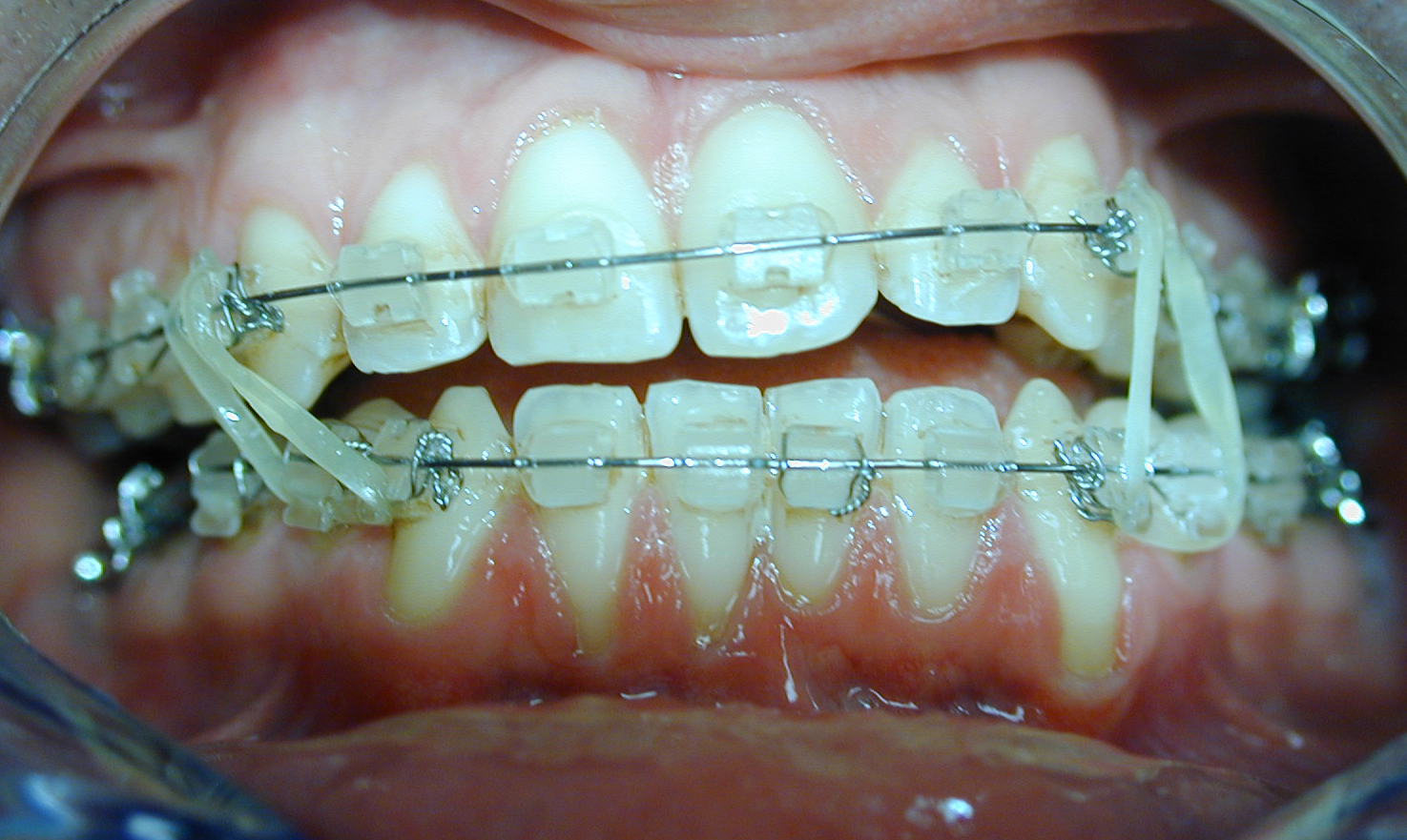 Una Boca para toda la Vida: Caso clínico de ortodoncia: TRATAMIENTO NO ...