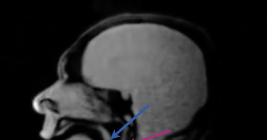 Velopharyngeal Insufficiency (VPI) After UPPP or Uvula Excision Surgery ...