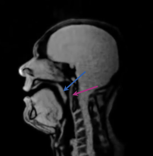 Velopharyngeal Insufficiency (VPI) After UPPP or Uvula Excision Surgery ...