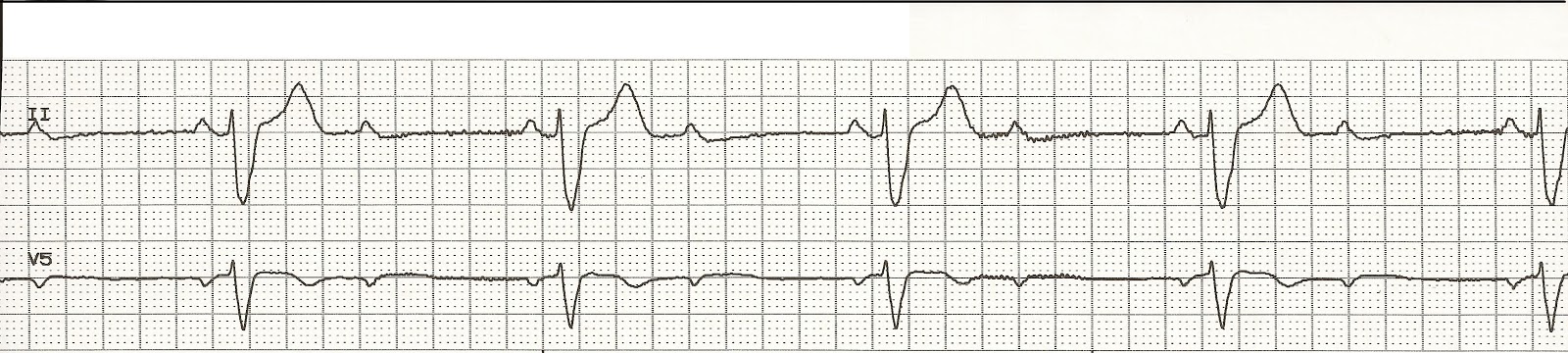 ACLS Rhythms: Heart blocks