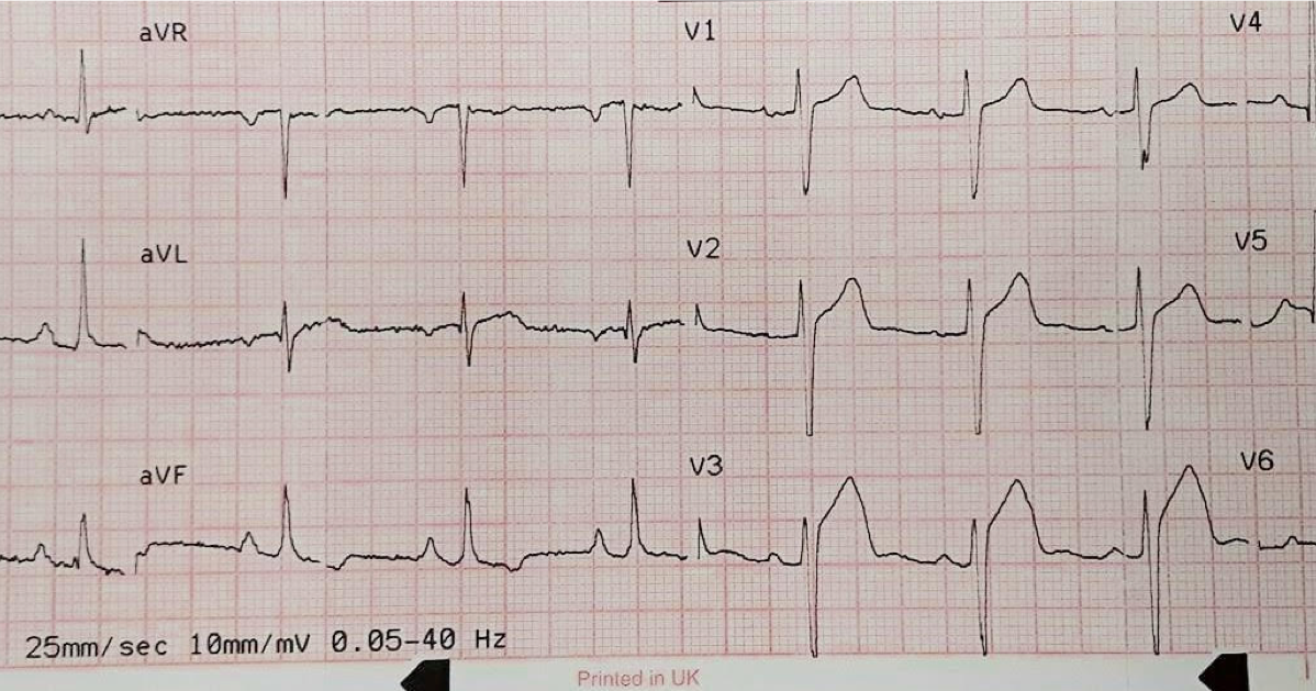 Dr. Smith's ECG Blog: Anterior STEMI? Or Benign Early Repolarization?