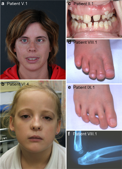 Préserver Ma Santé En Naturel: Le Syndrome de Carpenter