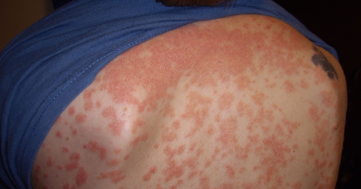 Psoriasis Improves After Tonsillectomy | Fauquier ENT Blog