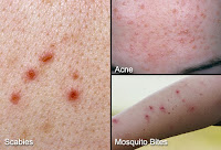 Healthy Life: Scabies