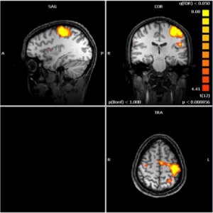Borsook's It's a Pain! Blog: Imagined movements in spinal cord injury ...
