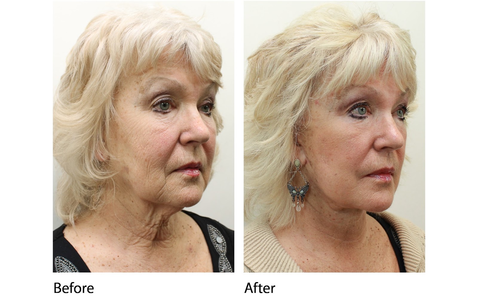 Dr. Darm, Aesthetic Medicine Blog: MiniLift Before and After Pictures
