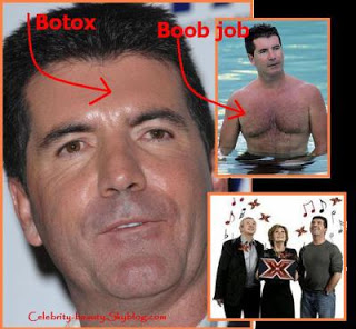 Simon Cowell Plastic Surgery Before and After Botox Injections and Facelift