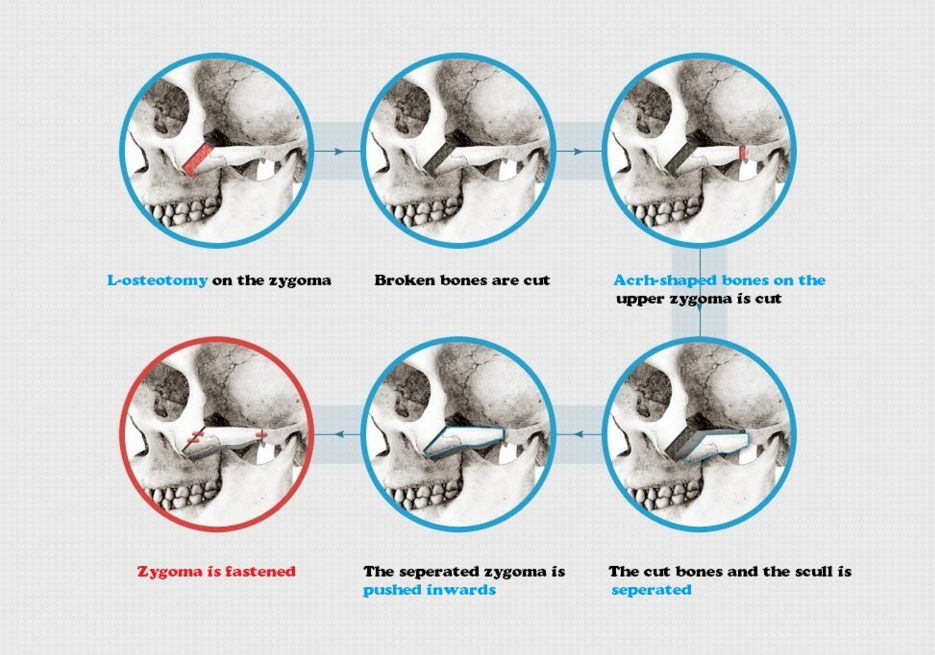 TL PLASTIC SURGERY CLINIC KOREA: Facial Contouring