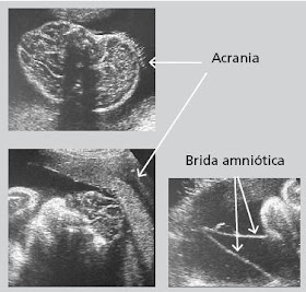 Ultrasonido Extrofia Vesical
