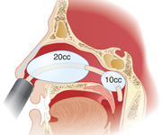 ENT for medical students: NOSE - Epistaxis