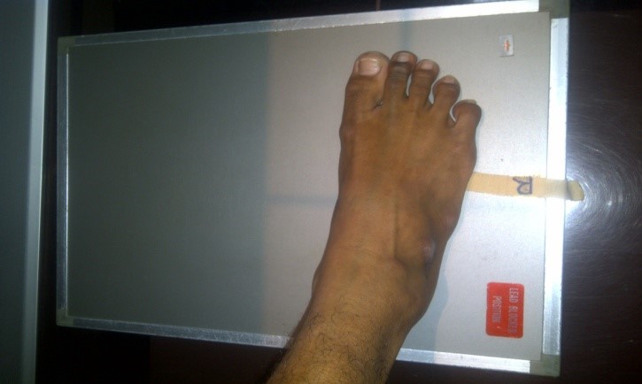 CONTOH MAKALAH RADIOLOGI | ANODE HEEL EFFECT | PENGARUH ANUDE HEEL ...