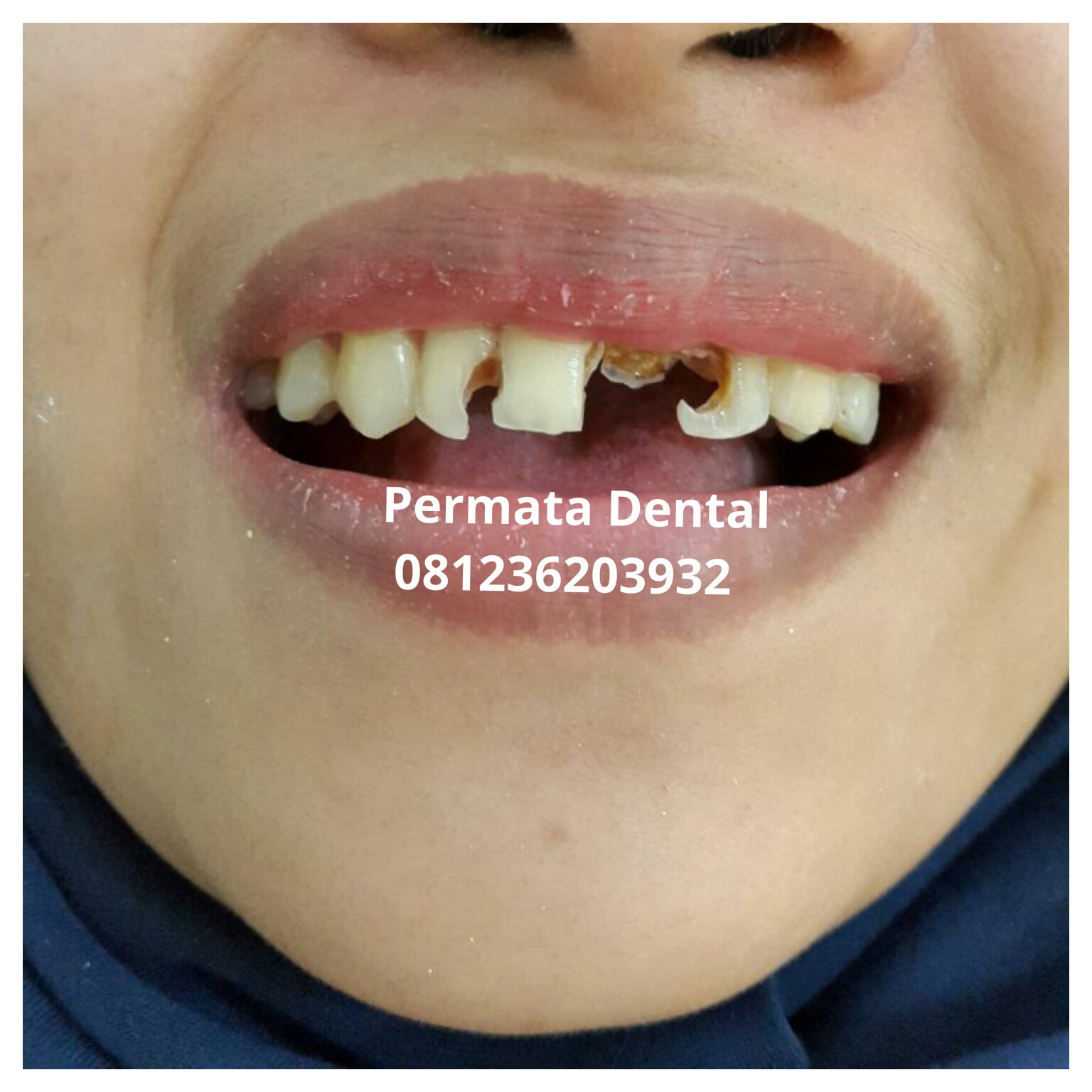 DOKTER GIGI BALI: Veneer Gigi | Samsung Gigi